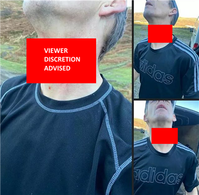 Cyclist left with horrendous neck injuries from hidden barbed wire trap